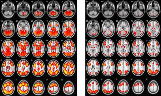 [보고서]Functional MRI를 이용한 조기 독성 뇌증의 고차인지기능장애에 관한 연구