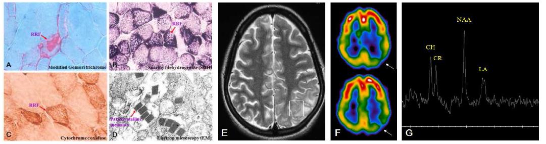 [보고서]핵-미토콘드리아 유전체의 공조적 결함에 의한 PEO 발병기전 규명 및 분자진단법 개발