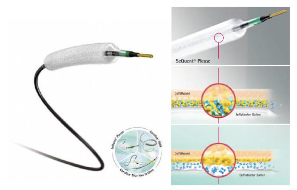 [보고서]혈관질환 치료용 면역억제제 방출 융복합 의료기기의 개발