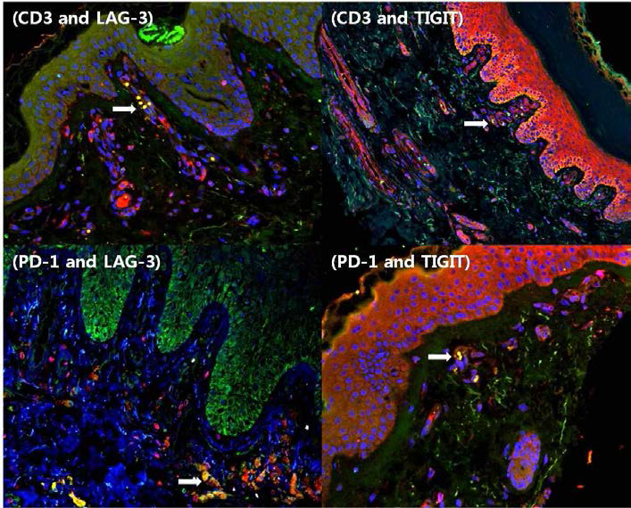 [보고서]면역표적치료제 관련 면역억제 물질, CD200, LAG-3, PD-1 단백질의 흑색종 tumor ...