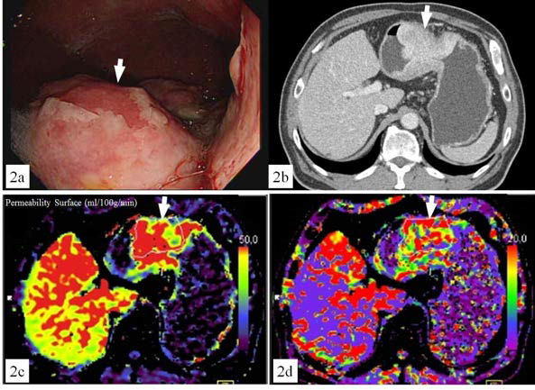 [보고서]진행성 위암환자에서 술전 병리학적 분화도 결정 및 항암치료 조기 반응 평가에서 조영증강 초음파, 관류 CT, 관류 ...