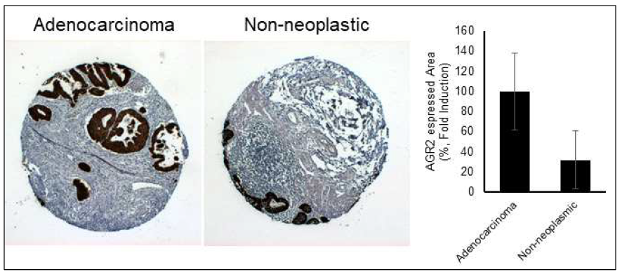 [보고서]미세 종양환경내 Anterior Gradient-2 (AGR2)의 유도 및 분해 기전연구